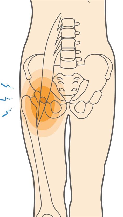 Iliopsoas Bursitis Injection