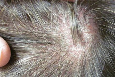 Itchy Red Spots On Scalp