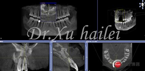块状骨移植 许海磊的博客 Kq88口腔博客