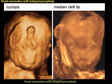 5 Fetal Face Ultrasound Dr Ahmed Esawy Pdf
