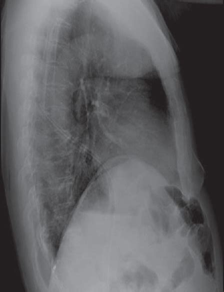 Computed Tomography Guided Pulmonary Nodule Microcoil Localization Technique Misplacement