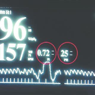 PDF Early Detection And Management Of Critically Sick Newborn In Neonatal Intensive Care Unit