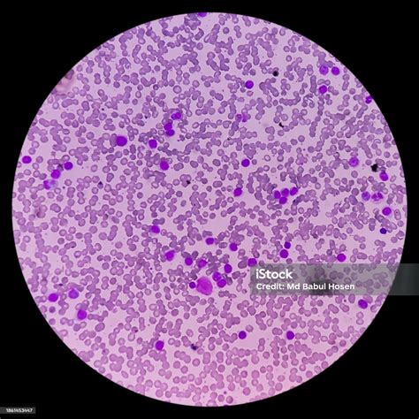 Foto De Leucemia Células Sanguíneas Blastos E Leucócitos Imaturos Na