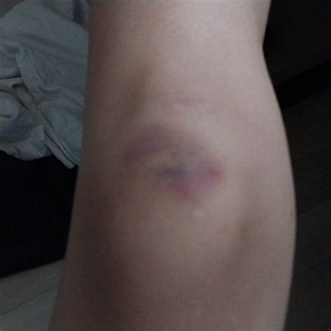 이유 없이 생긴 무릎 멍 지식in