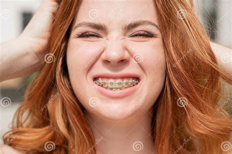 Close Up Portrait Of A Young Red Haired Woman With Braces On Her Teeth