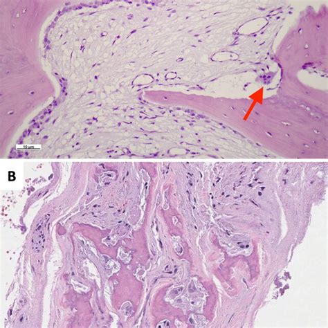 A Histological Analysis Of Newly Formed Bone Tissue Harvested From The