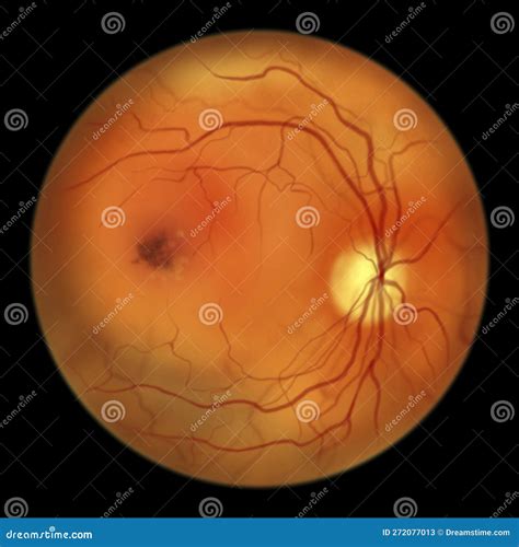 Best Vitelliform Macular Dystrophy Atrophic Stage Retinal Atrophy Illustration Royalty Free