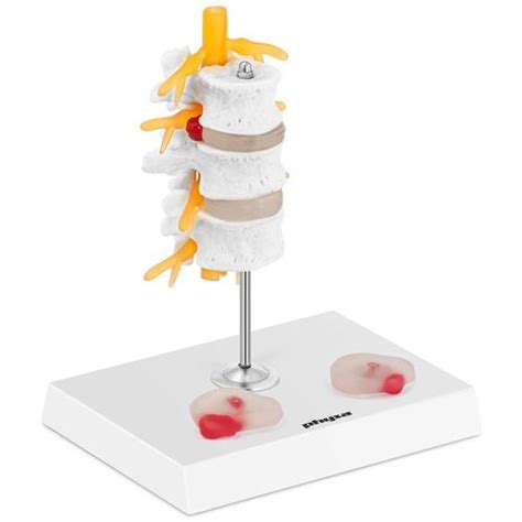 Modèle Anatomique Disque Intervertébral Avec Hernie Discale Lombaire