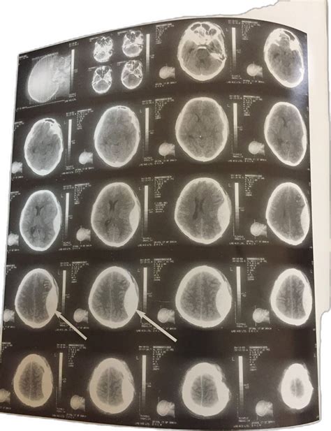 Ct Scan Of Brain 9 Ct Scan Brain Scan Brain