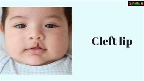 Cleft Lip When Was Discovered