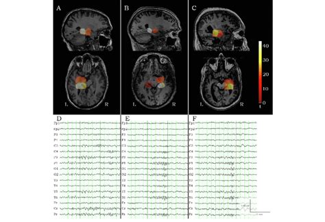 Representative Samples Of Statistical Parametric Mapping SPM Of Download Scientific Diagram