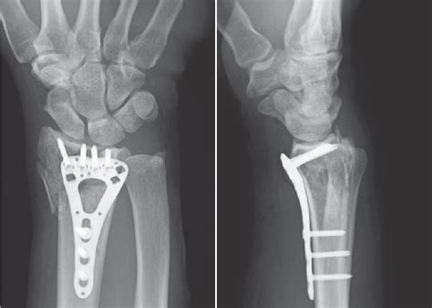 Wrist Fracture Open Reduction And Internal Or Externa