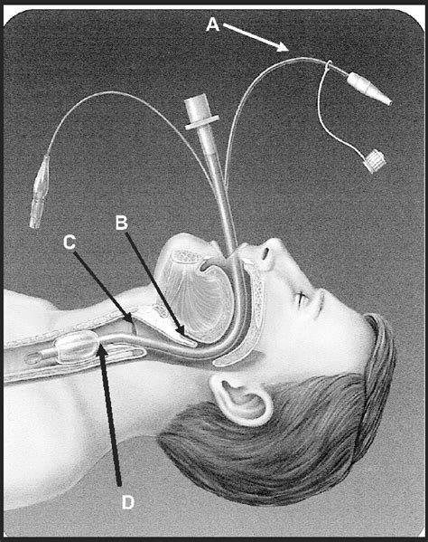 Hi Lo Evac Endotracheal Tube A Line For Aspiration Of Subglottic