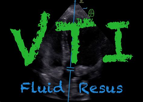 Cardiac Vti The New Ivc For Fluid Responsiveness — Usf Emergency Medicine