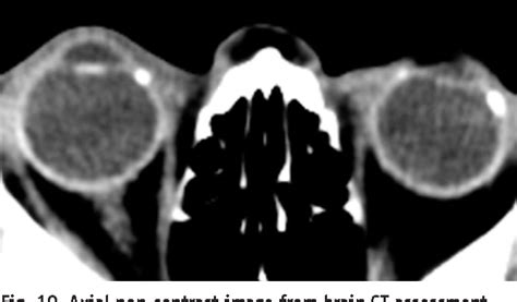 Pdf Eye Globe Abnormalities On Mr And Ct In Adults An Anatomical