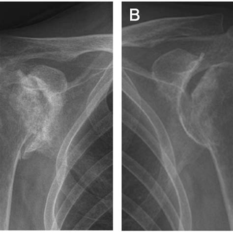 Radiograph A Of A Proximal Humerus Fracture The CT Scan With D Download Scientific Diagram