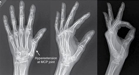 Revision Carpometacarpal Joint Arthroplasty Clinical Tree