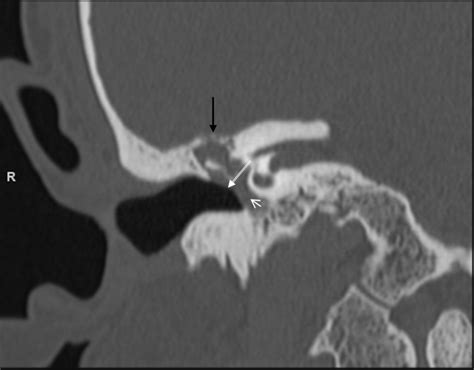 Tegmen Tympani Dehiscence Anatomical Features Of Intratemporal Course