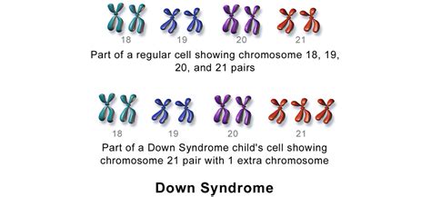 Wat Is Downsindroom Gansbaai Pharmacy Xplorio™ Gansbaai