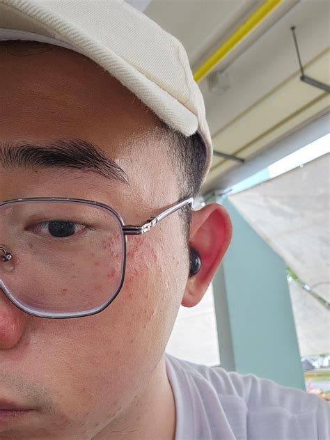 Is This Kp R Keratosis