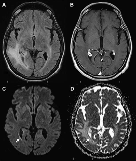 Diffusion Imaging In Brain Infections Radiology Key