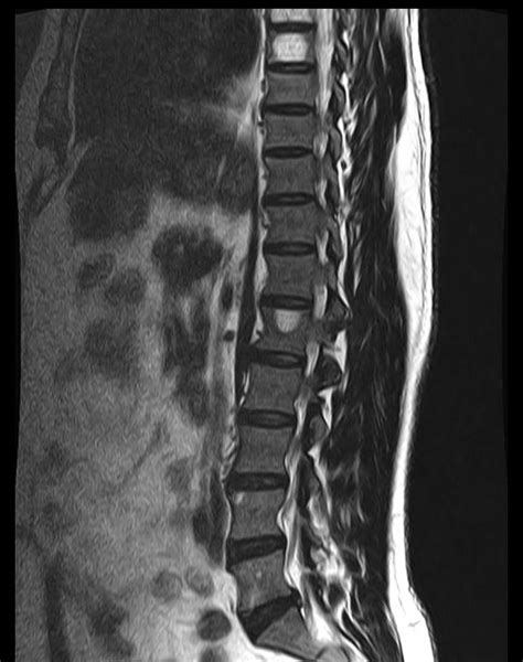 Quotminquot Vertebral Hemangioma Vertebral Angioma Symptoms