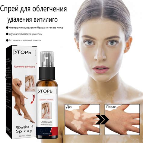 Спрей для облегчения удаления витилиго Спрей для восстановления кожи при витилиго для ухода за