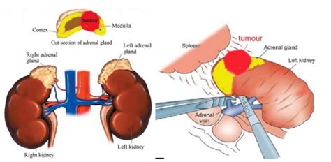 Robotic Laparoscopic Adrenalectomy Chin Chong Min Urology And Robotic Surgery Centre
