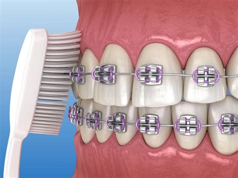 Toothbrush Cleaning Braces Process Medically Accurate 3d Illustration