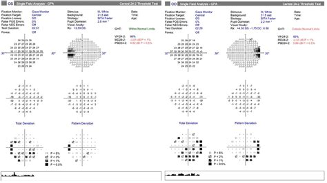 Visual Field Loss And Lesions Along The Visual Pathway
