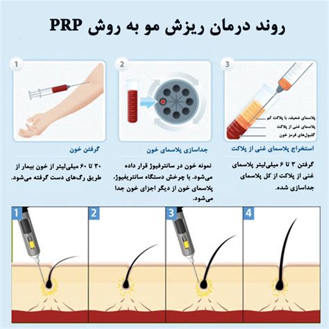 Prp درمانی چیست؟روند Prp درمانی اثرات جانبی كلينيك تخصصى پوست و مو آبنوس