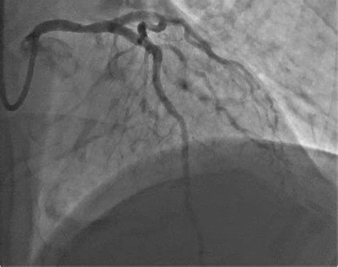 Microscopy Showing 30 40 Occlusion Of The Lmca Download Scientific Diagram