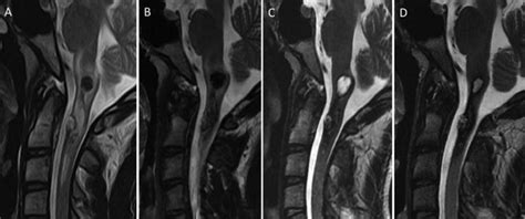 Spinal Cavernomas Mri T1 Signal Evolution Of Bleeding Cavernoma Upper Download Scientific