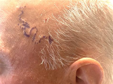 Technical Strategies Dopper Assessment Of Temporal Artery Ligations Explore Plastic Surgery