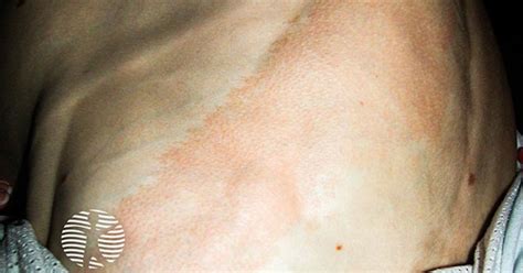 Proteus Syndrom Skjelett Radiologic Manifestations Of Proteus Syndrome