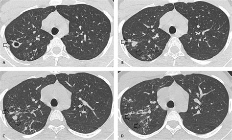 A D Axial Computed Tomography Sections Of Lung Showing Multiple Download Scientific Diagram