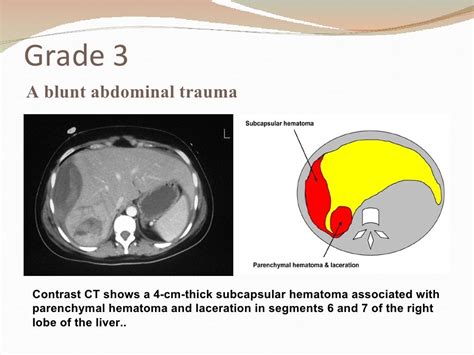 Liver Trauma