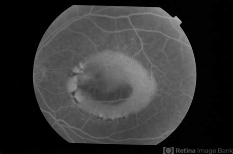Chronic Atypical CSCR Retina Image Bank