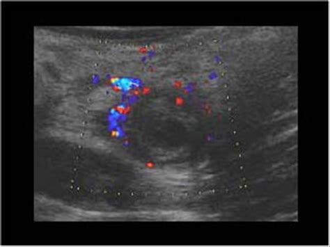 Abdomen And Retroperitoneum 1 5 Appendix Case 1 5 2 Uncomplicated Appendicitis Ultrasound
