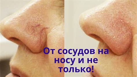 Без операции Как убрать сосуды на носу и не только Своими руками аптечные средства от