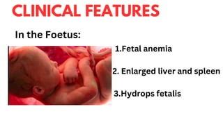 Erythroblastosis Fetalis Presentation Explained Bestt PDF Pregnancy Reproductive Health