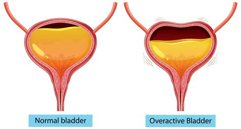 Overactive Bladder Symptoms Causes And How To Cope Effectively