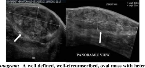 Figure 2 From Multimodality Imaging Of Giant Breast Hamartoma With