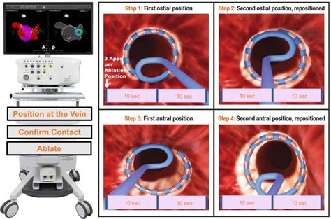 Varipulse A Step‐by‐step Guide To Pulmonary Vein Isolation Logan S