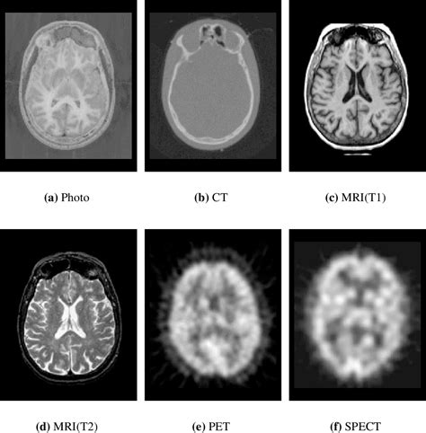 Figure 11 From On Noise Reduction In Iterative Image Reconstruction Algorithms For Emission