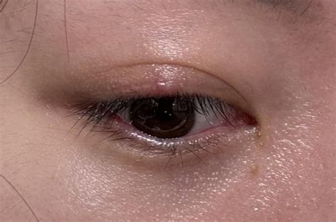 Meibomian Gland Dysfunction And Blepharitis R Dryeyes