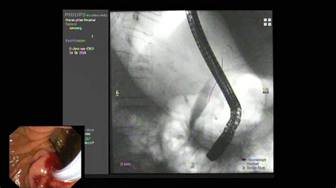 Ercp Intradiverticular Ampulla Cannulation Youtube