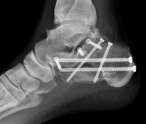 Comminuted Fracture Of The Calcaneus Who Wants To Play Tic Tac Toe