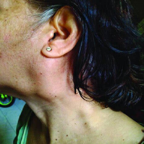 A Year Old Woman Complained Of A Palpable Masses In The Neck Area Download Scientific Diagram