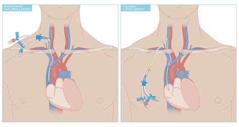 Differences Between Tunneled Non Tunneled Central Venous 51 Off